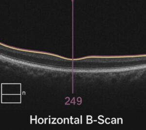 CIRRUS OCTのGanglion Cell解析を徹底解説｜GCL+IPLの意味とレポートの見方 | 0.5ミリ先